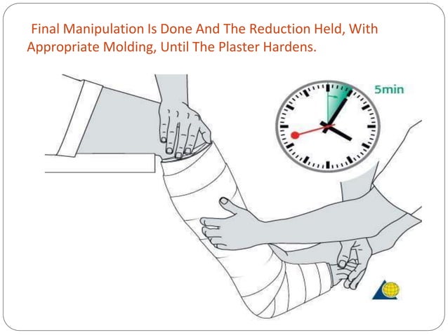 POP PLASTER AND CAST TECHNIQUES | PPTX | First Aid | Injuries