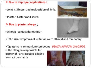 POP PLASTER AND CAST TECHNIQUES | PPTX