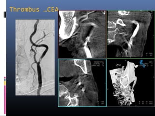 Carotid Artery Stenting | PPT