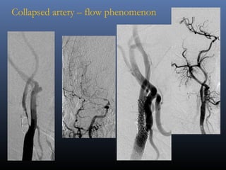 Carotid Artery Stenting | PPT