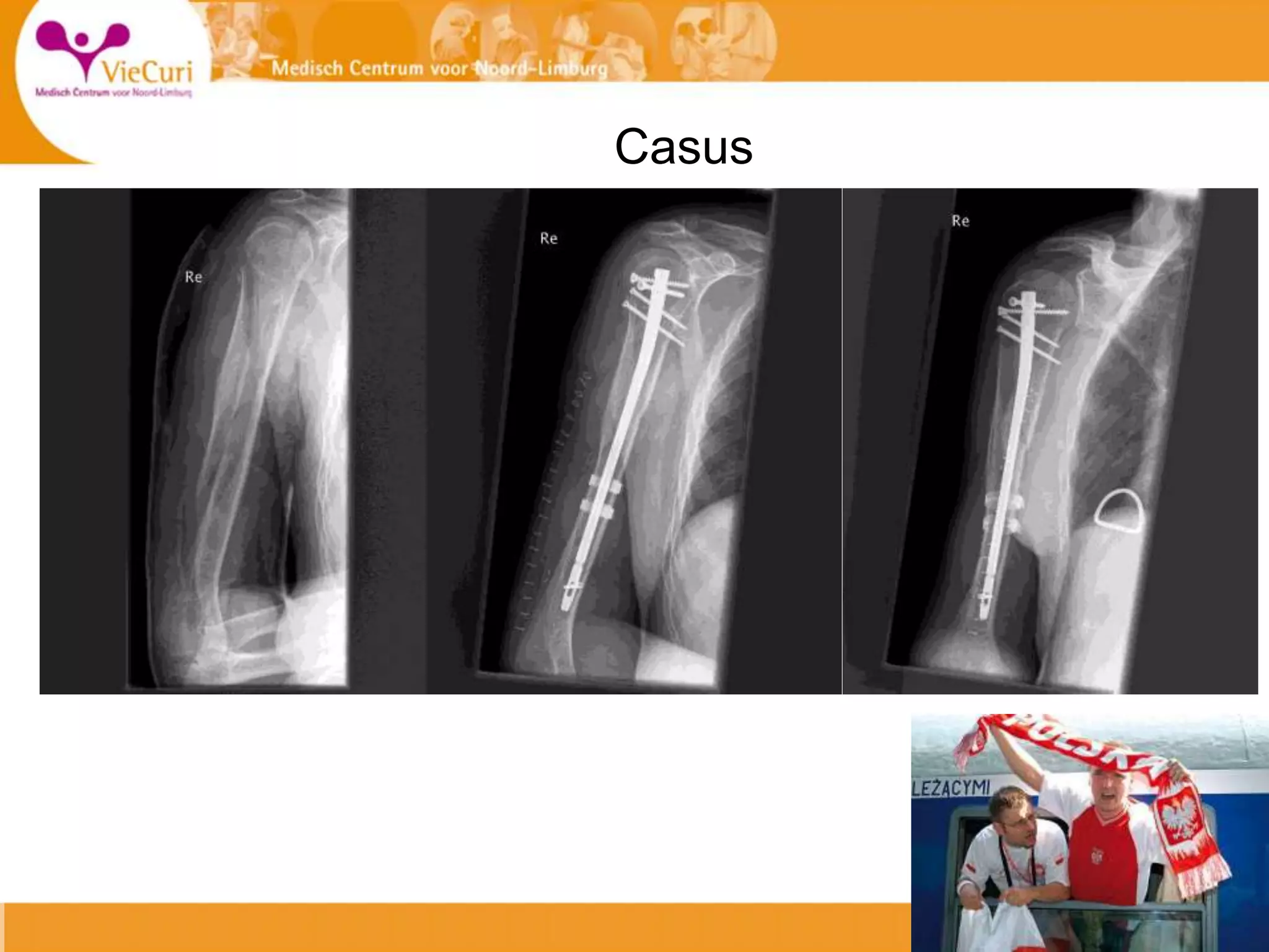 Plating versus intramedullary nailing for humeral shaft fractures in ...