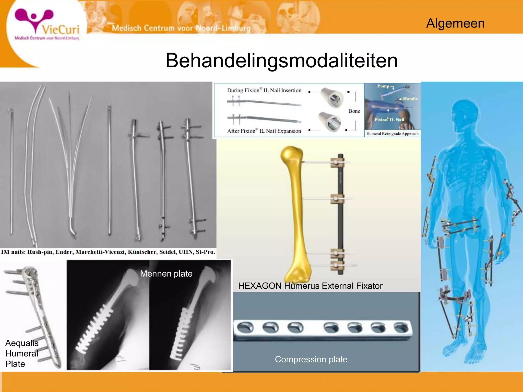 Plating versus intramedullary nailing for humeral shaft fractures in adults - a systematic ...