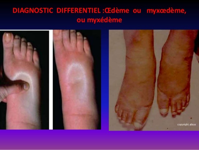 CAT devant des Oedemes des Membres Iinférieurs. Pr.Jamil HACHICHA