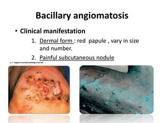 Cat scratch disease-and_bacillary_angiomatosis[1] | PPT