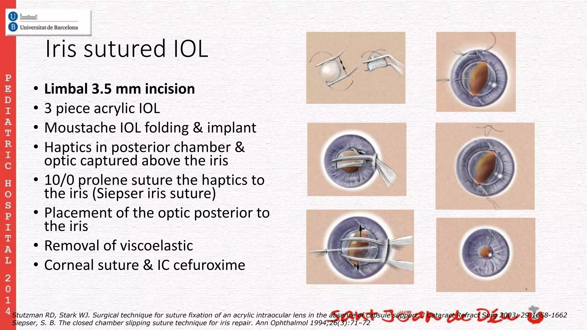 IOL implantation in the absence of capsular bag | PPTX