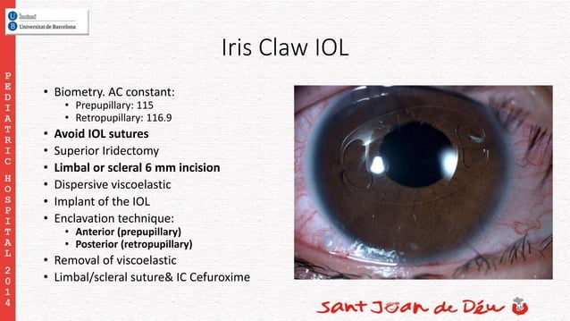 IOL implantation in the absence of capsular bag | PPTX | Eye and Vision ...
