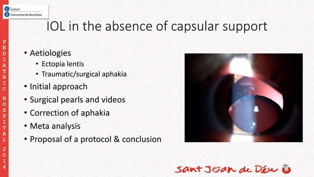 IOL implantation in the absence of capsular bag | PPTX | Eye and Vision ...
