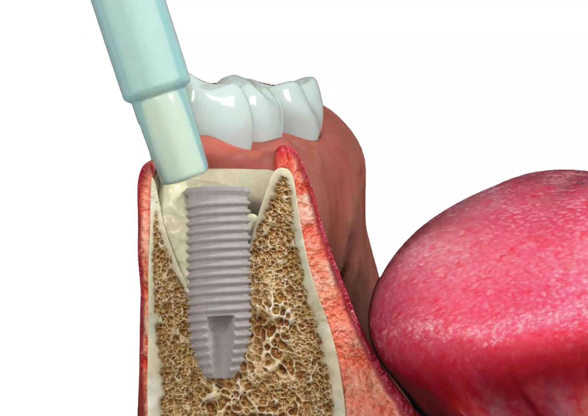 Catalog Osteobiol 2020 EN | PDF