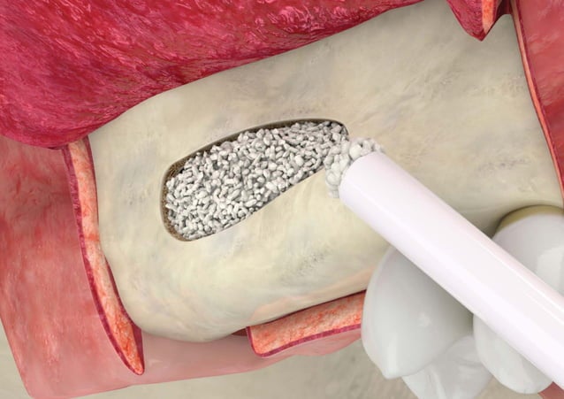 Catalog Osteobiol 2020 EN | PDF | Bone and Joint Conditions | Diseases ...