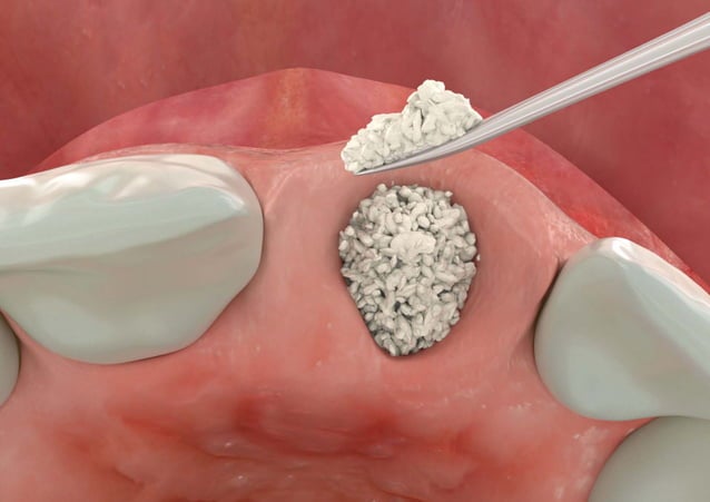 Catalog Osteobiol 2020 EN | PDF | Bone and Joint Conditions | Diseases ...