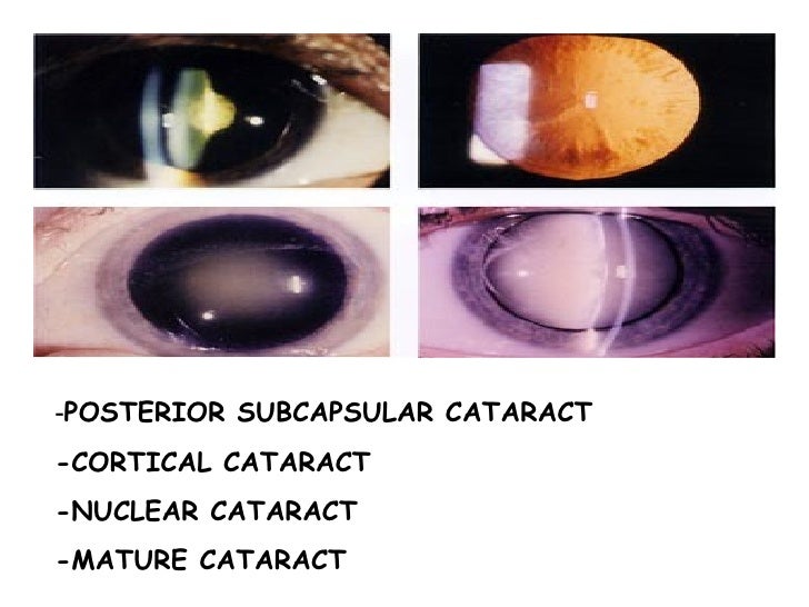 Cataract