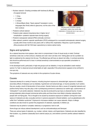 Cataract | PPTX