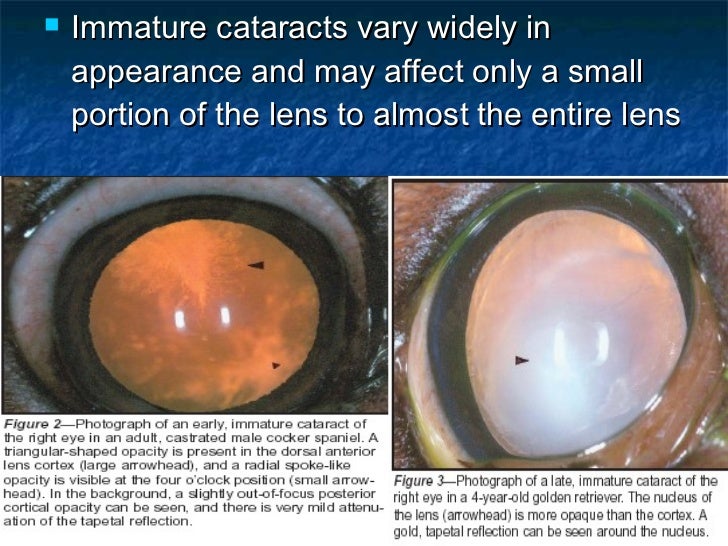 Immature Cataract