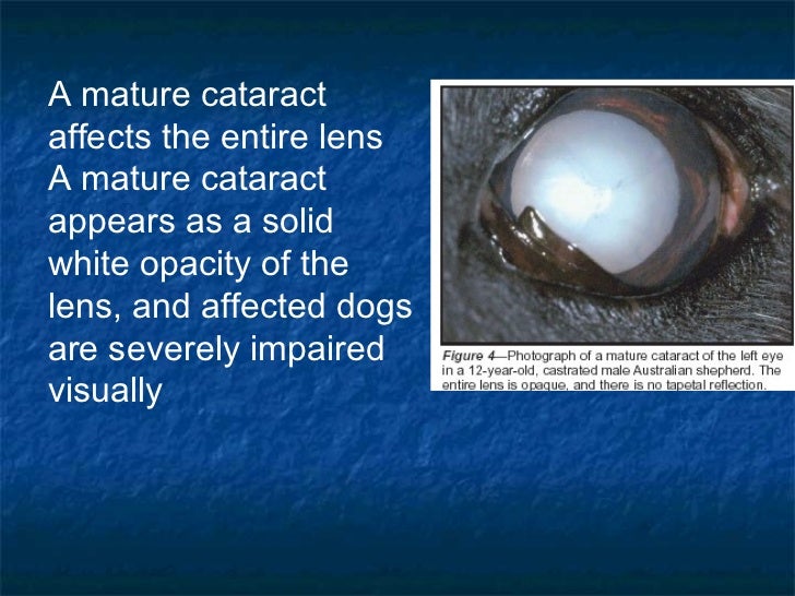 Cataract Definition