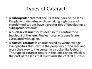 Cataract | PPTX