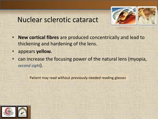 Cataract | PPTX