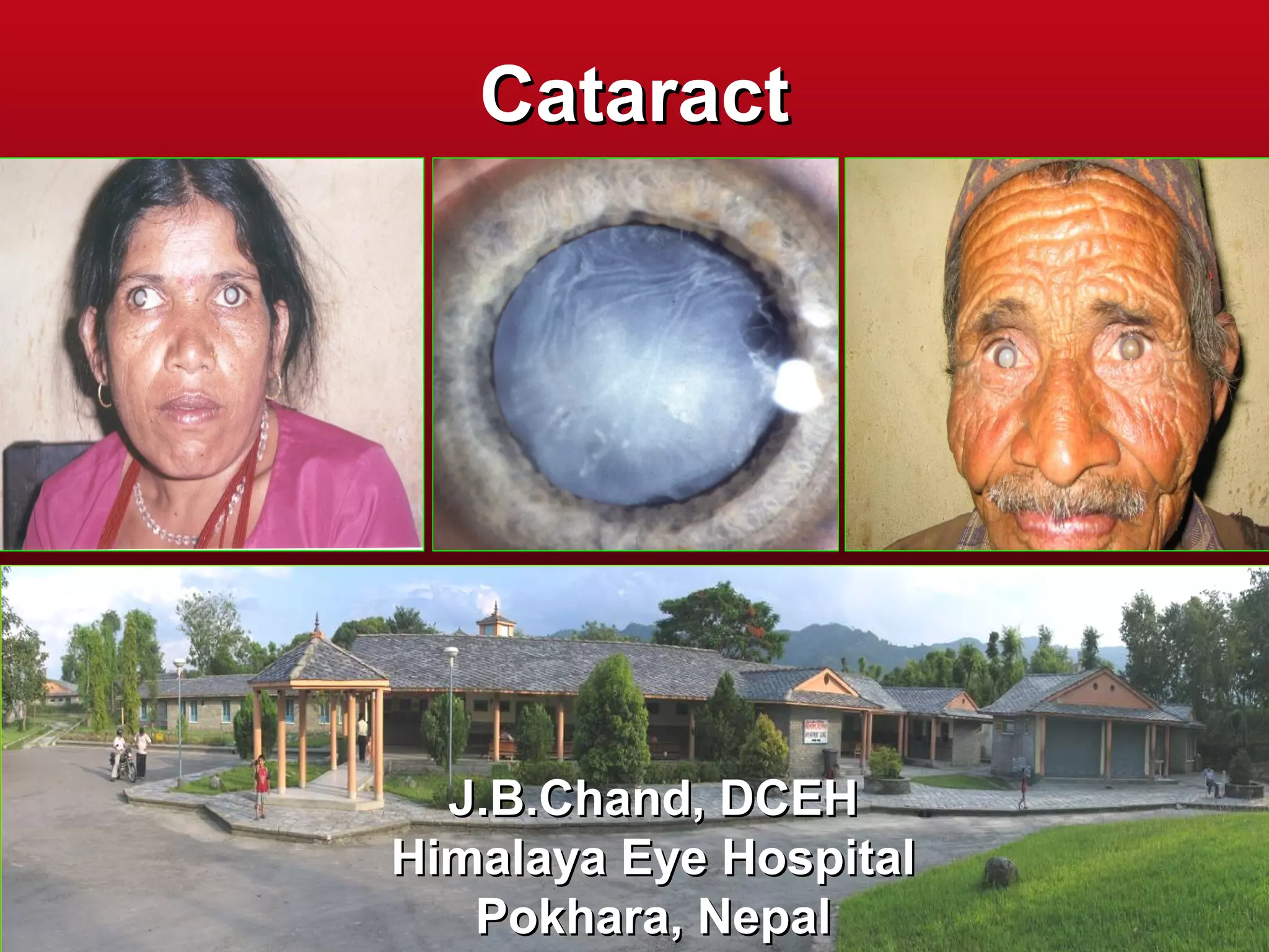 Cataract | PPT
