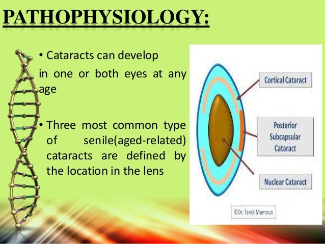 Cataract.