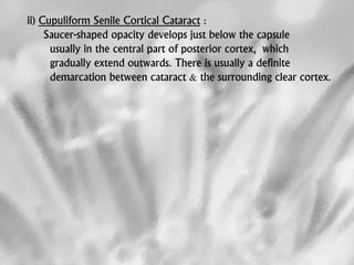 Cataract | PPTX