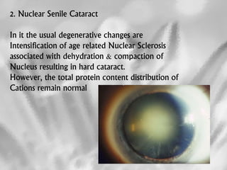 Cataract | PPTX