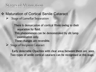 Cataract | PPTX
