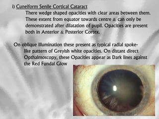 Cataract | PPTX