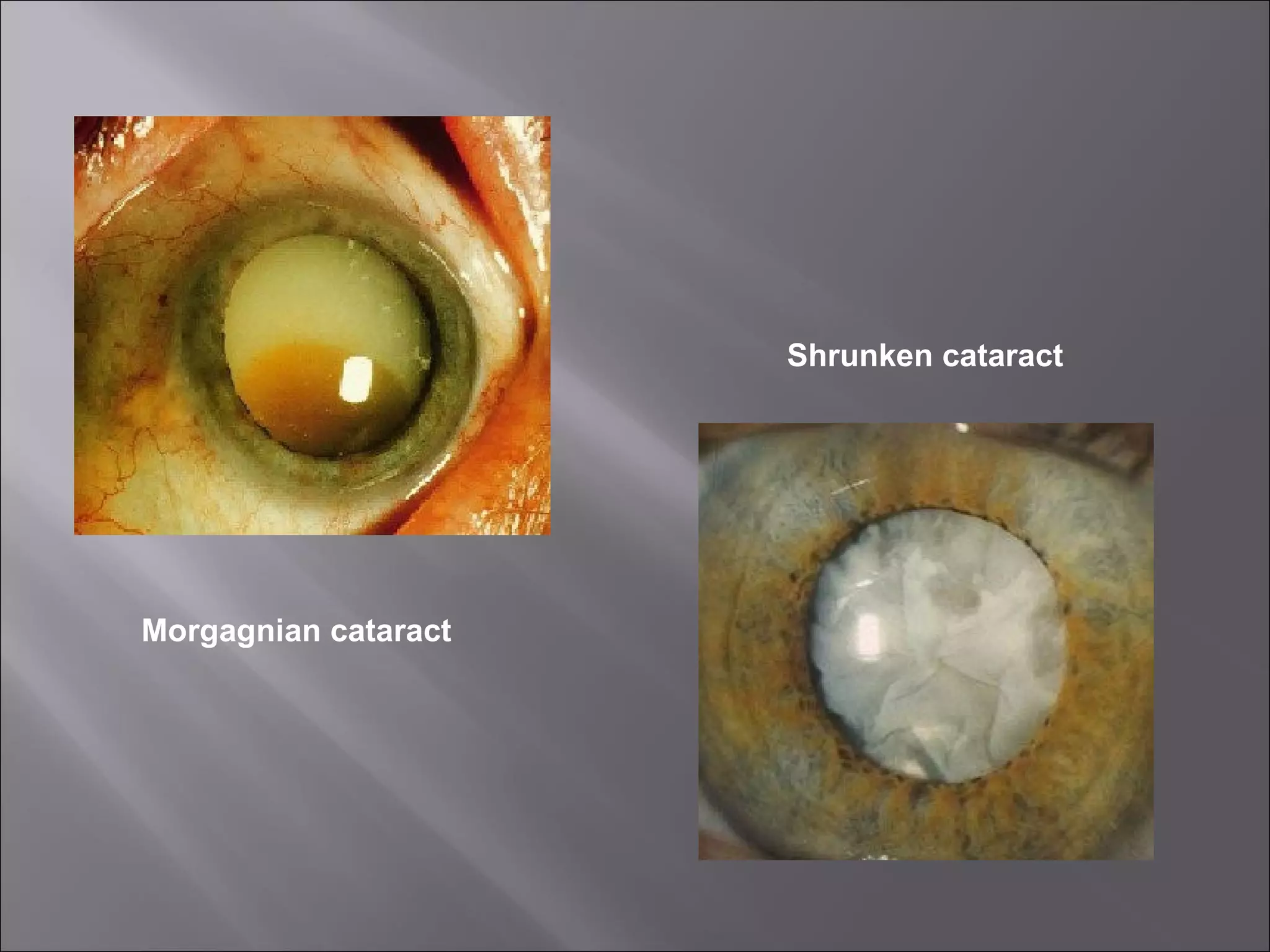 Cataract | PPT