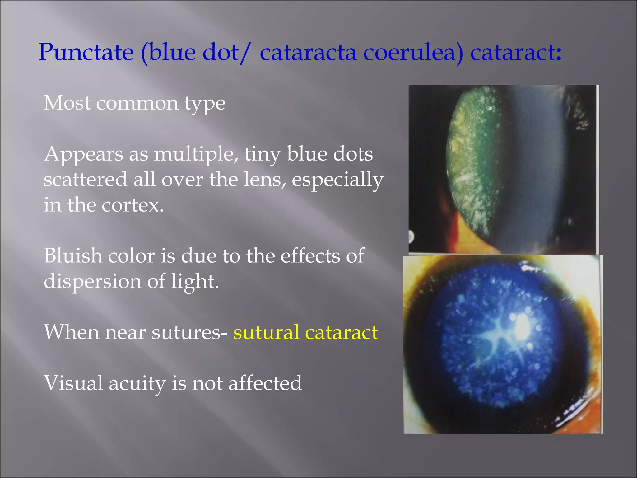 Cataract | PPT