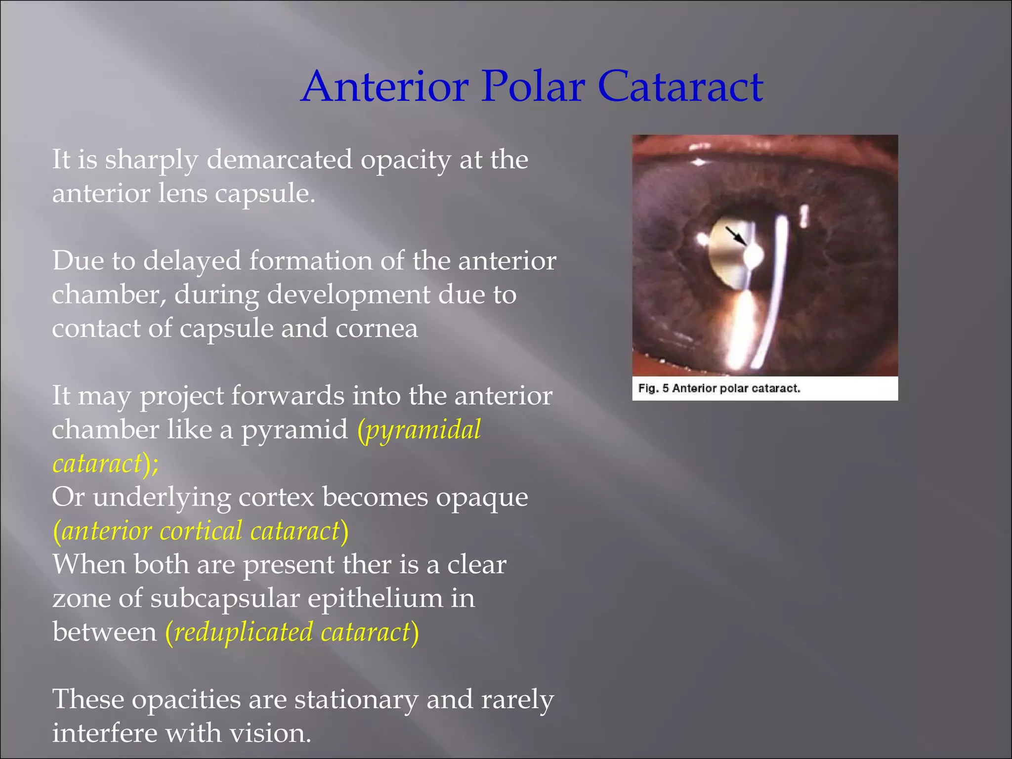 Cataract | PPT