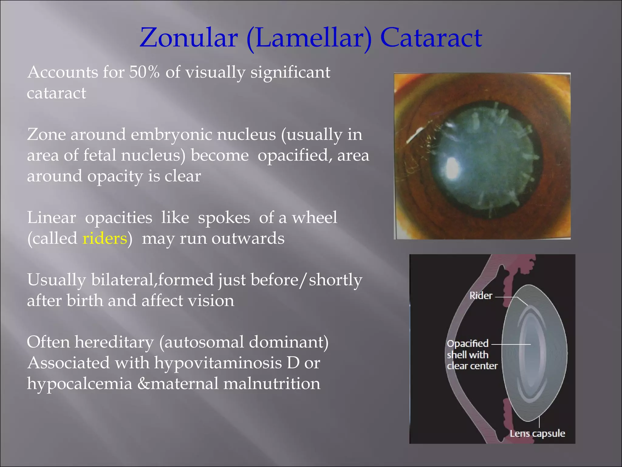 Cataract | PPT