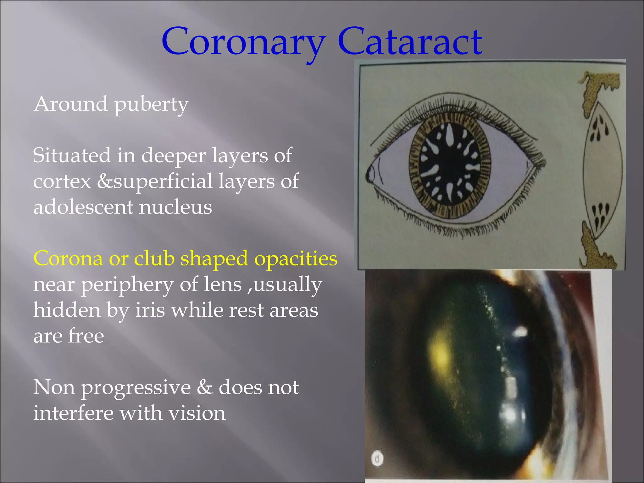 Cataract | PPT