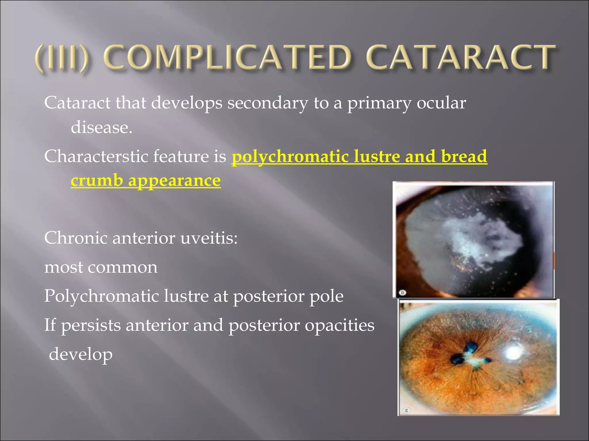Cataract | PPT