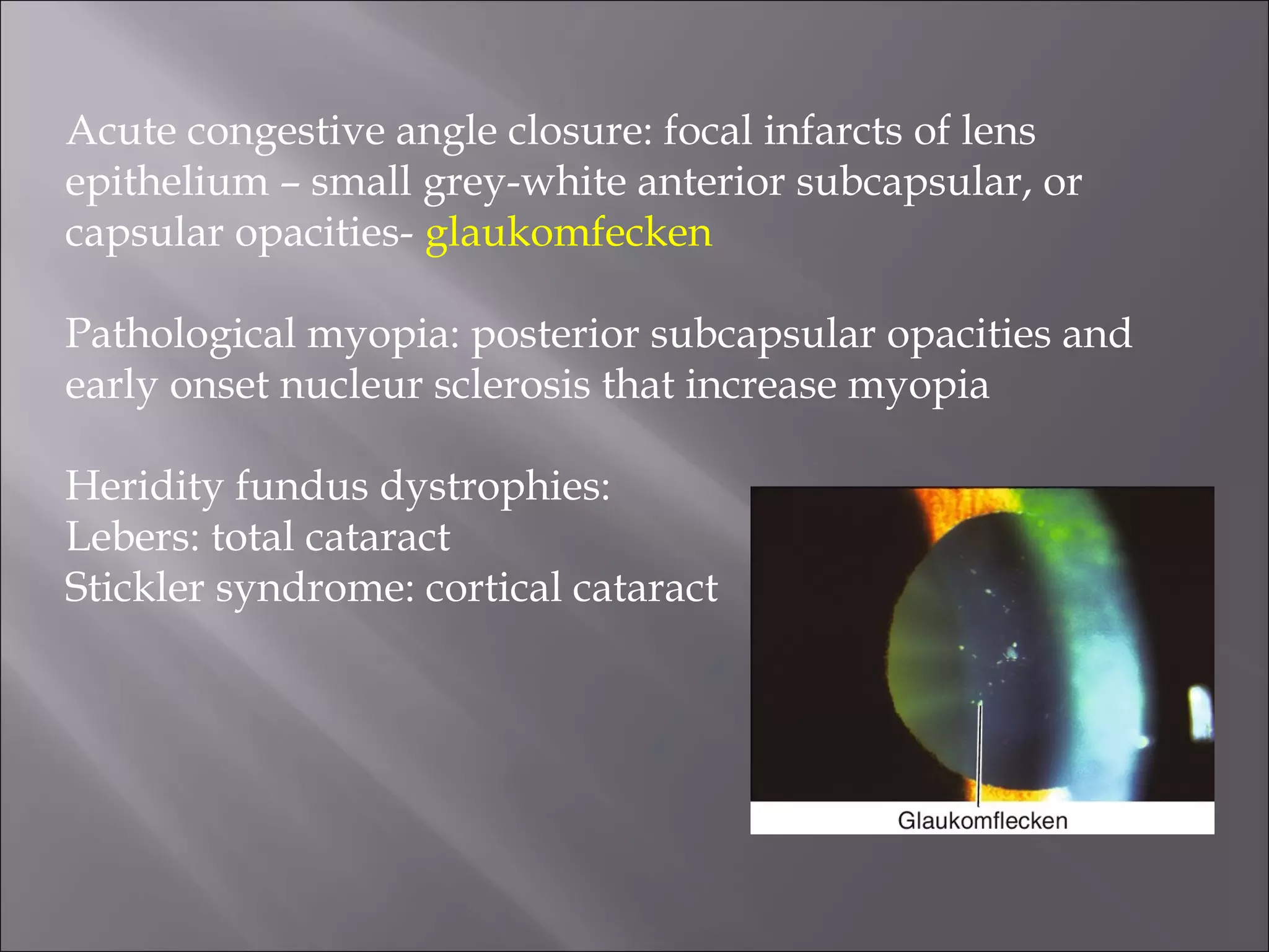 Cataract | PPT
