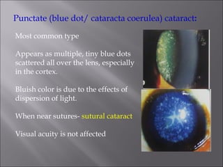Blue Dot Cataract
