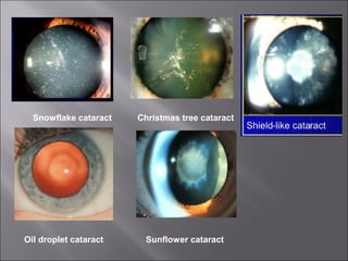 Snowflake Cataract