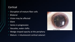 Cataract | PPTX