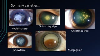 Snowflake Cataract