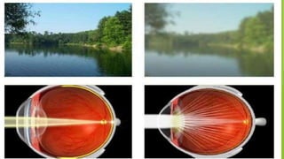 Cataract | PPTX