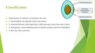 Cataract | PPTX