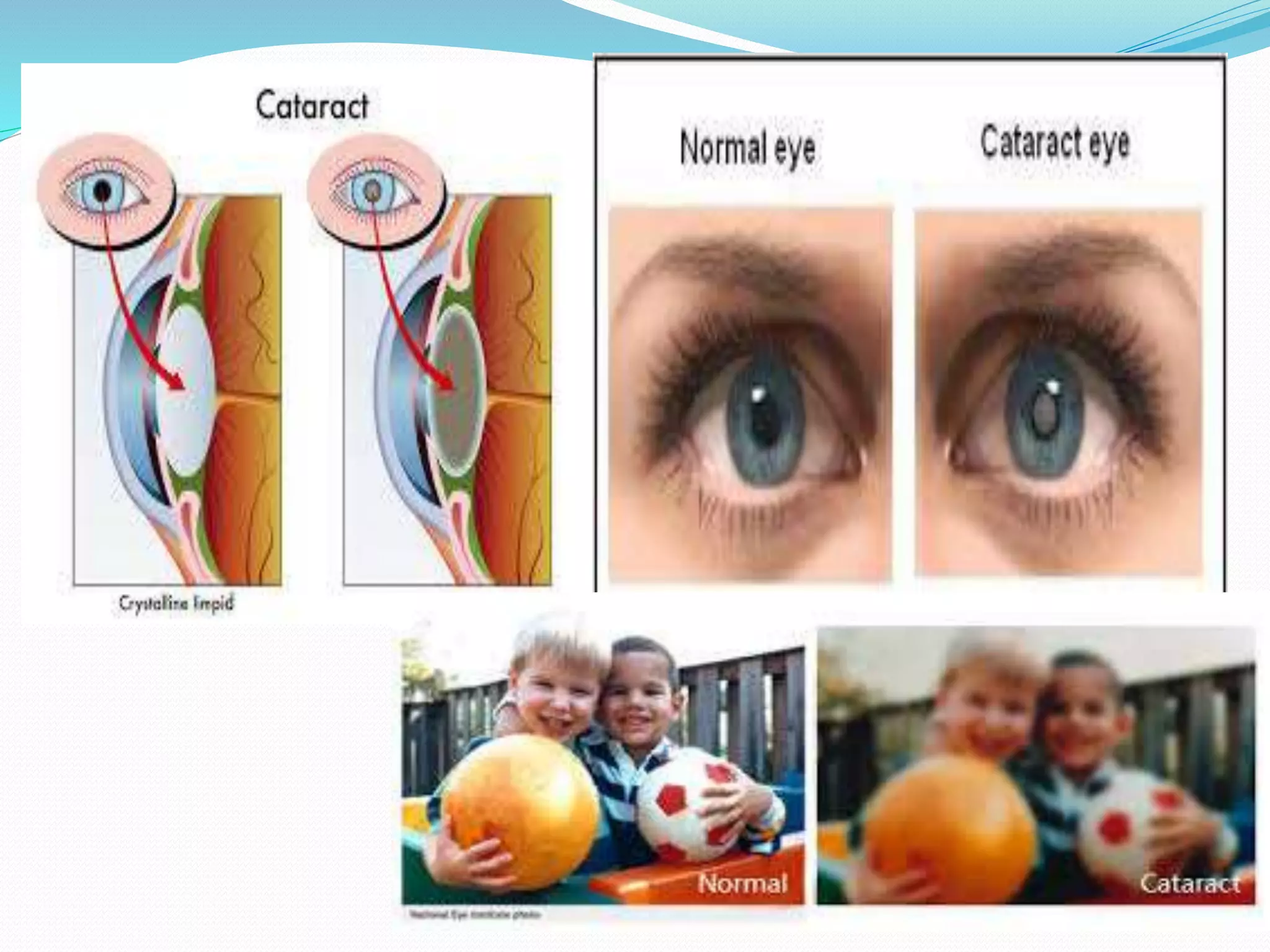 Cataract | PPT