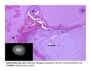 Cataract | PDF