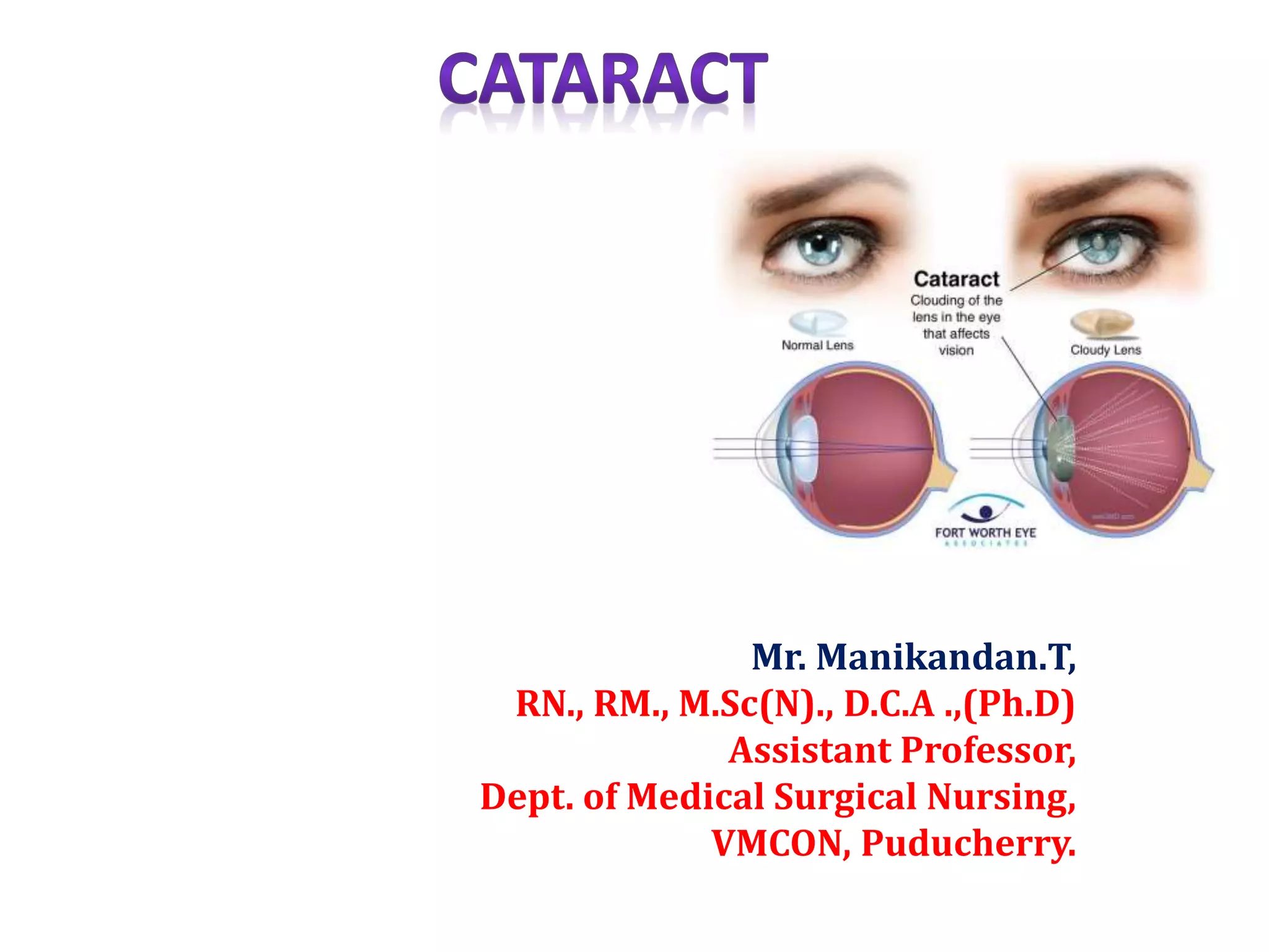 Cataract | PPTX