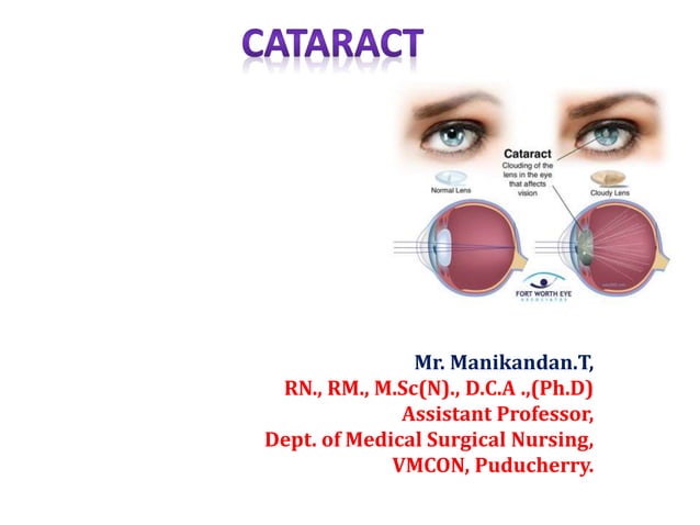 Cataract | PPTX | Eye and Vision Conditions | Diseases and Conditions