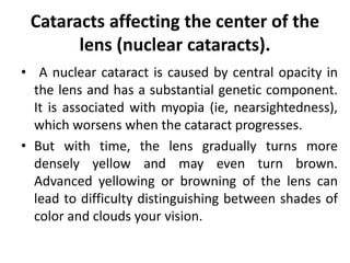 Cataract | PPTX