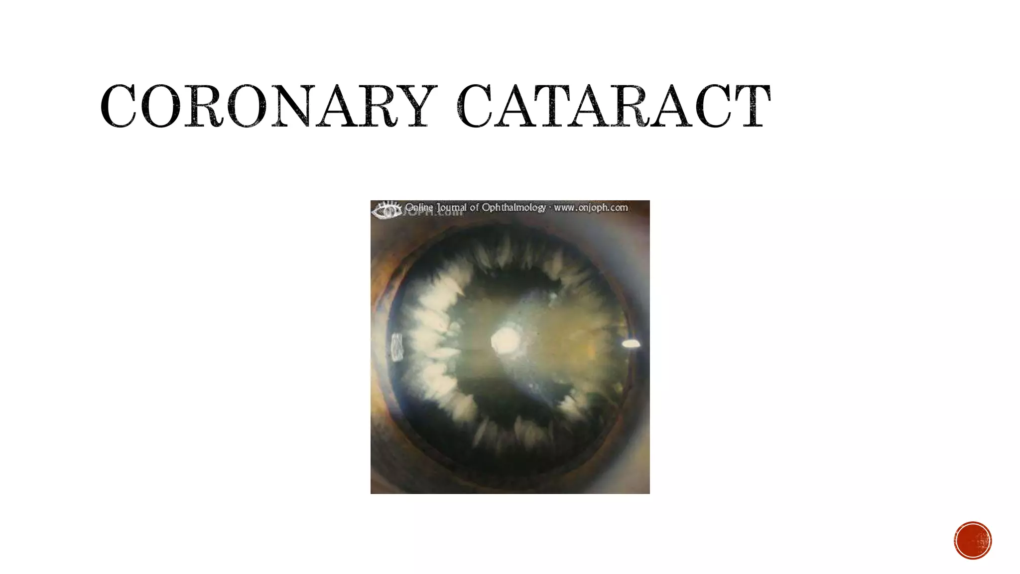 Cataract revisionnotes ophthalmology | PPTX