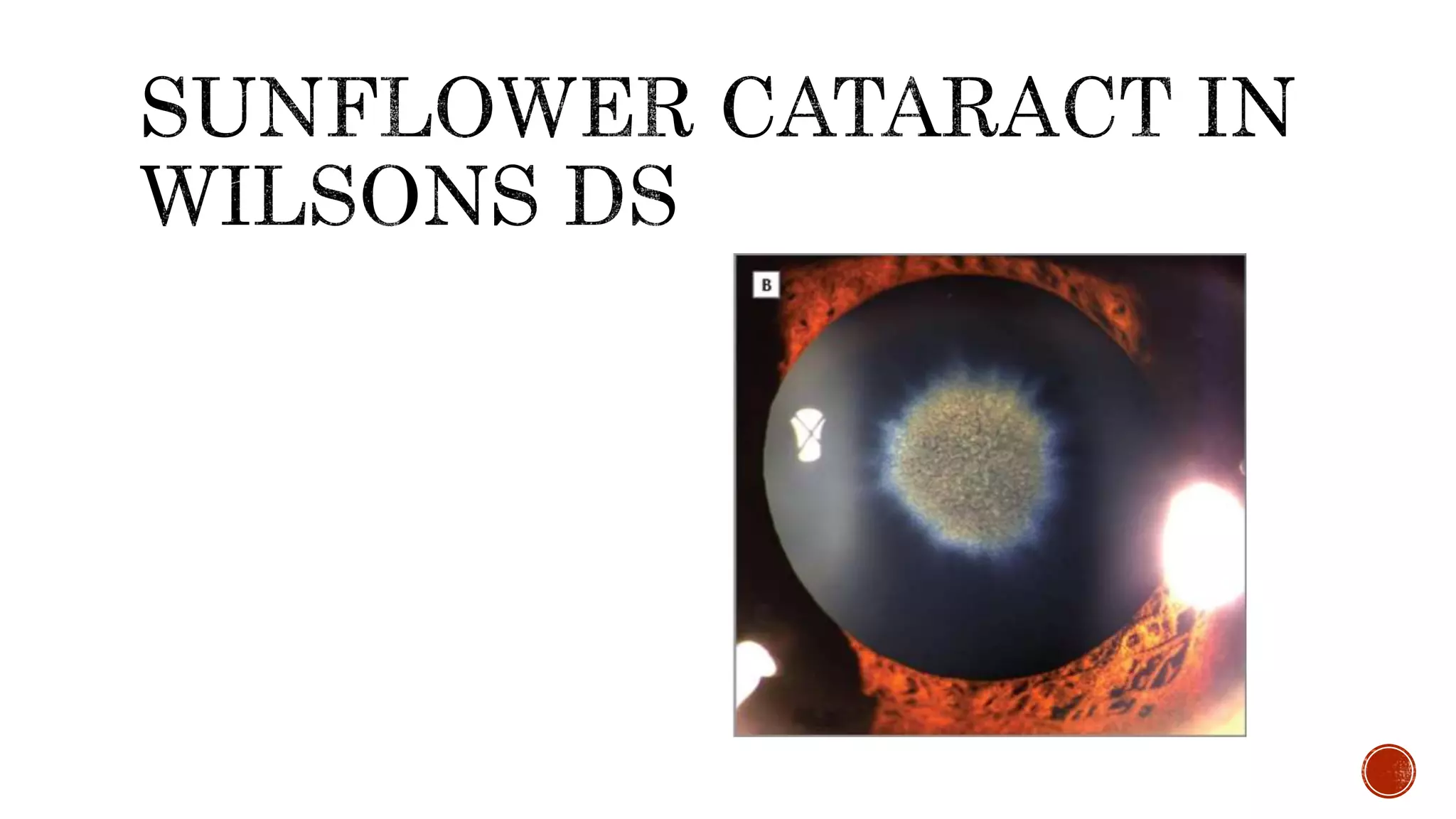 Cataract revisionnotes ophthalmology | PPTX