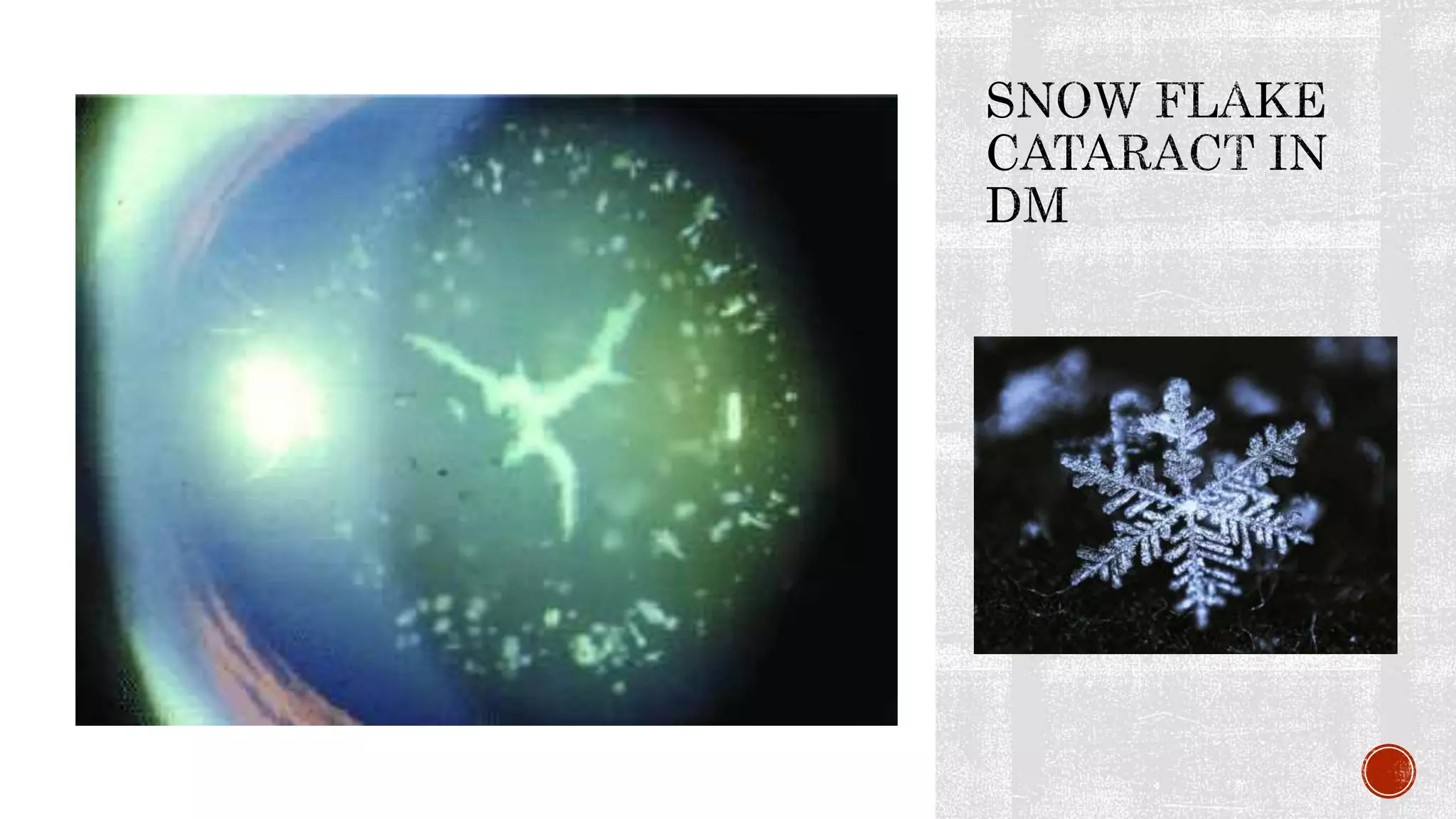 Cataract revisionnotes ophthalmology | PPTX | Eye and Vision Conditions ...