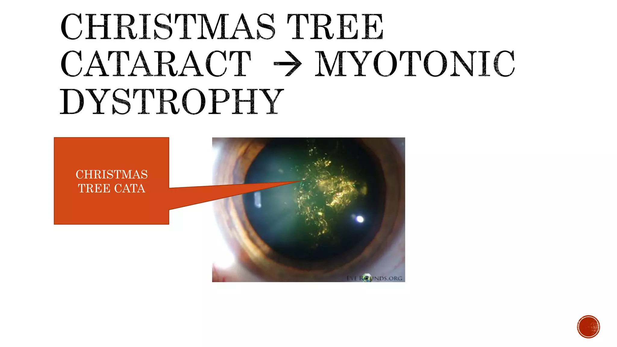 Cataract revisionnotes ophthalmology | PPTX