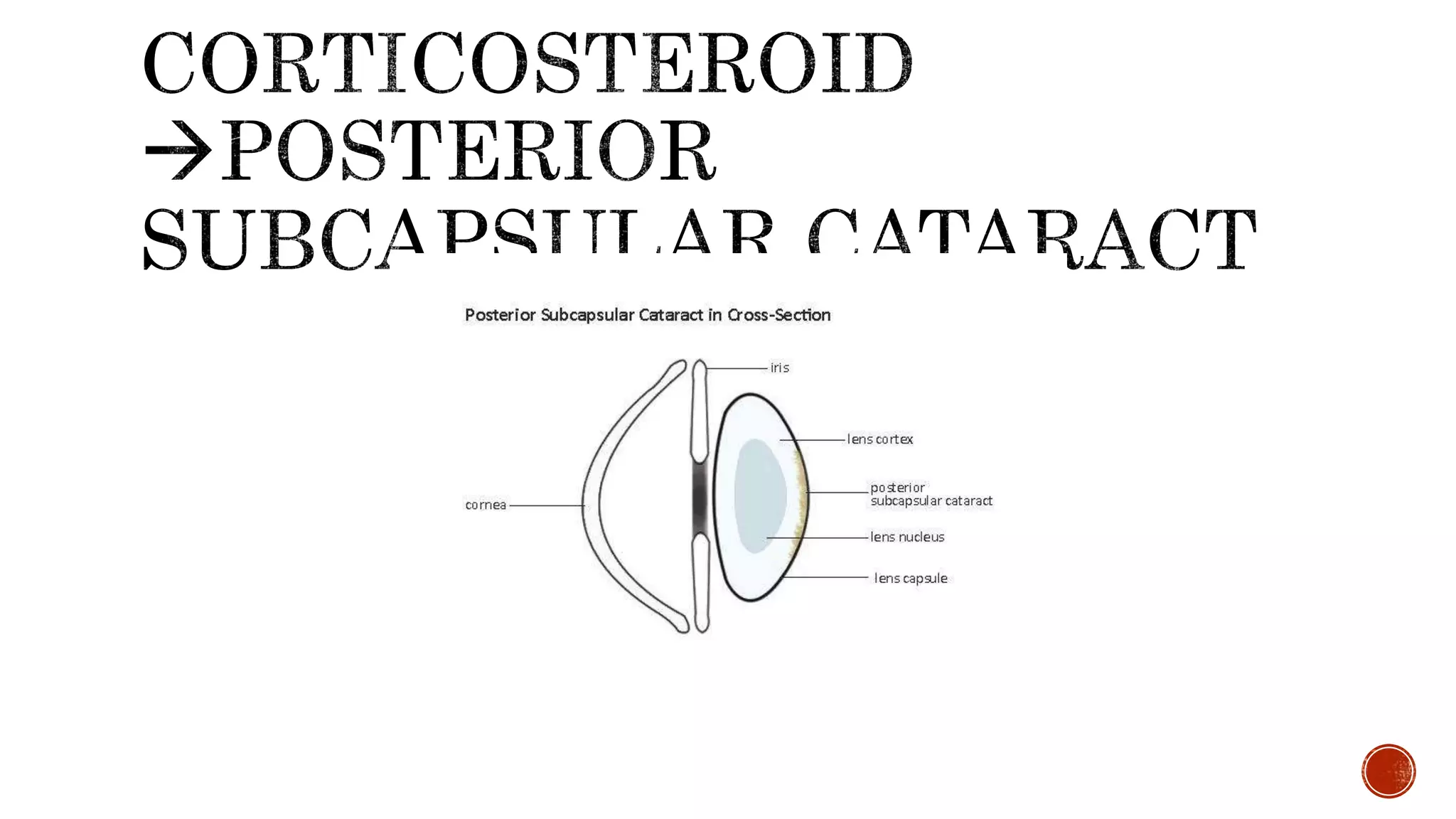 Cataract revisionnotes ophthalmology | PPTX