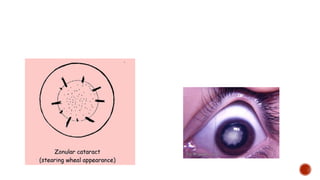 Cataract revisionnotes ophthalmology | PPTX